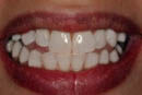 Whitening Smile Gallery - Brooklyn Cosmetic Dentist, Implants ...
