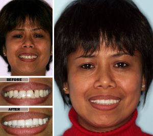 Bone Loss Surgery in Brooklyn NY | Bone Grafting