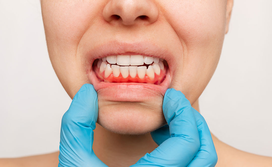 Gum Disease in Brooklyn, NY | Gingivitis Treatment