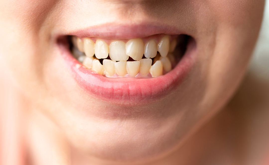 Brooklyn Impacted Tooth Surgeon