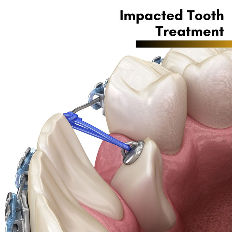 Brooklyn Impacted Tooth Surgeon