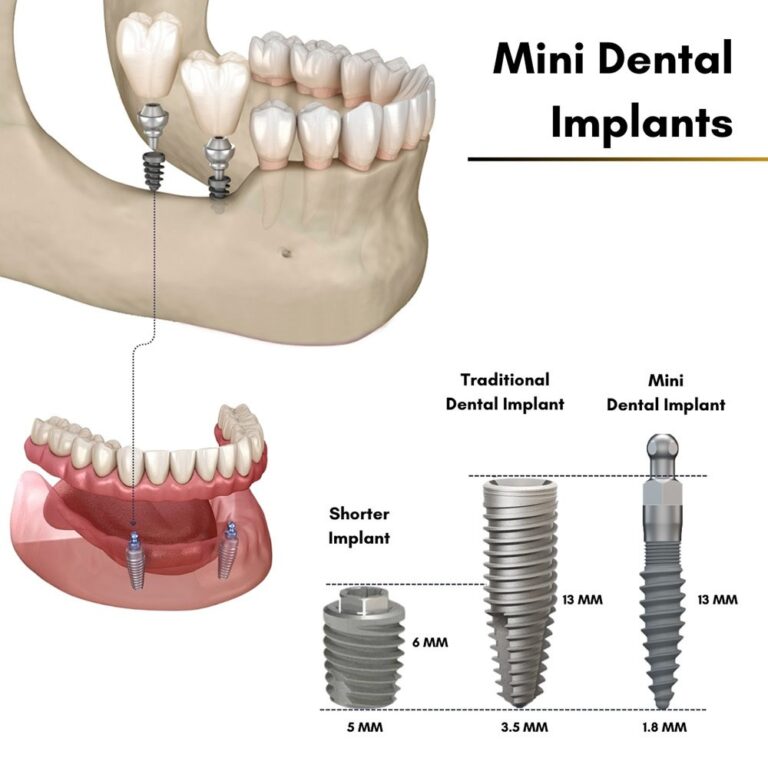 Mini Dental Implants vs. Traditional Implants | Envy Smile Dental Spa